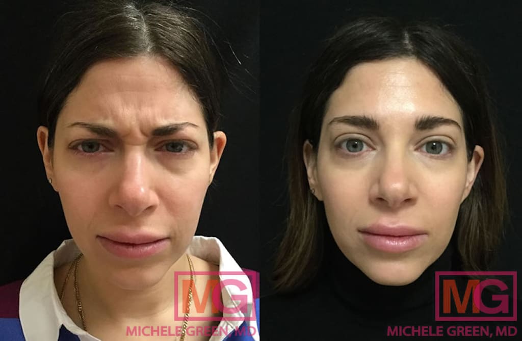How Baby Botox Helps Keep Your Baby Face